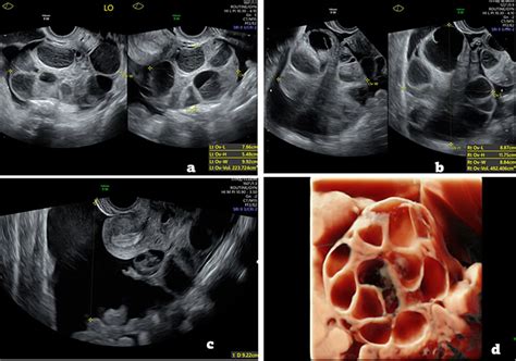 Role Of Ultrasound In The Diagnosis Of Benign Ovarian Masses Article