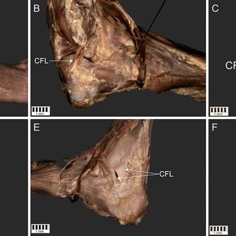 Types Of The Calcaneofibular Ligament Morphology Cfl Calcaneofibular