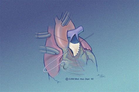 Ptfe Monocusp Valve For Rvot Reconstruction Ctsnet