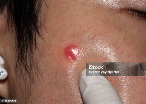 아시아 남자의 얼굴에 여드름 Vulgaris 여드름은 모낭이 기름과 죽은 세포로 막힐 때 발생합니다 여드름에 대한 스톡 사진 및 기타 이미지 Istock