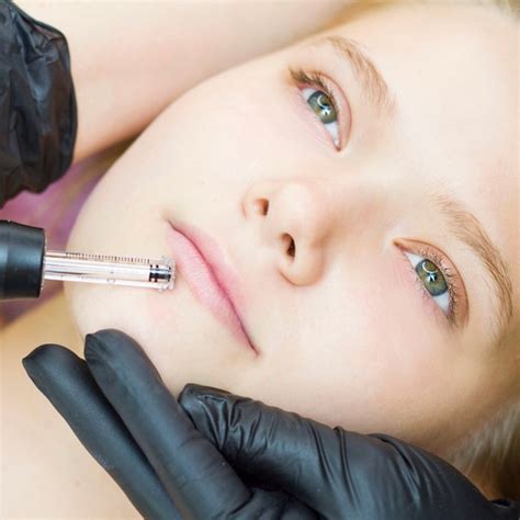 Hyaluron Pen Fillers In Stuart And Delray Beach Needle Free Lip Enhancement