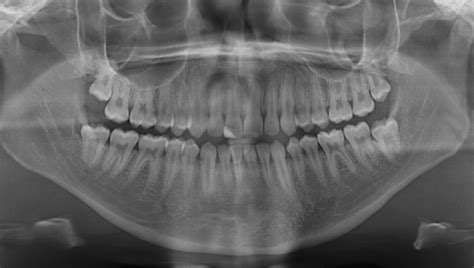Teethsegmentation3 Instance Segmentation Dataset By Md Anas