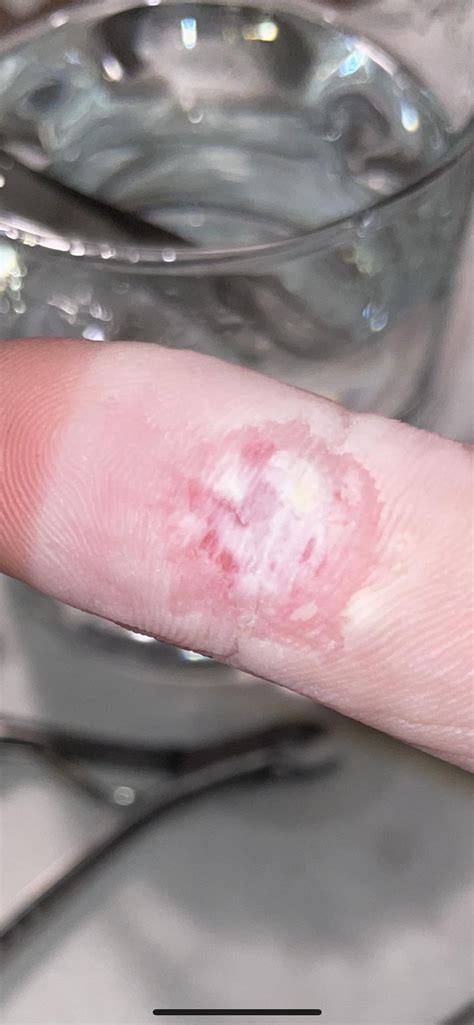 Update On Pointer Finger This ‘final Trimming Is Filled With Hope I
