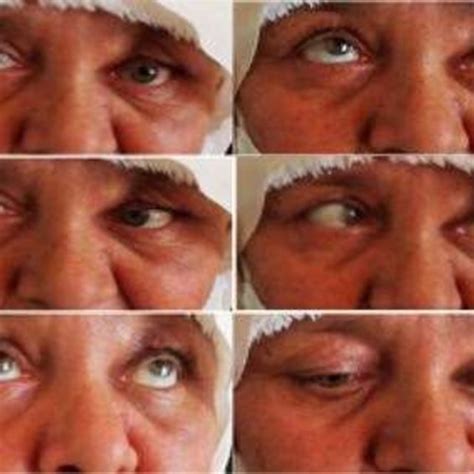 Pre Operative Clinical Examination Showing Mildly Restricted Ocular Download Scientific Diagram