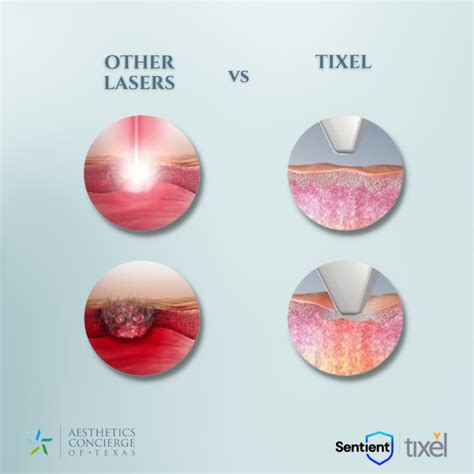 Transform Your Skin With Tixel The Revolutionary Laser Treatment