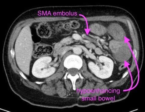 Small Bowel Ischemia Pacs