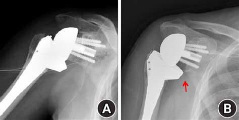 A Immediate X Ray Showing Graft Placement On The Glenoid B Download Scientific Diagram