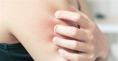 How To Stay Safe From Summertime Bug Bites