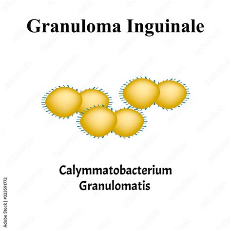 Inguinal Granuloma Bacterial Infections Sexually Transmitted Diseases Infographics Vector