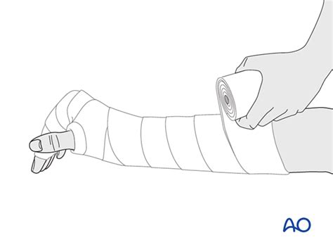 Application Of A Dorsal Splint To Hand And Wrist