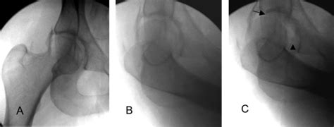 A C Fluoroscopic Views Showing The Dynamic Examination Of Hip Download Scientific Diagram
