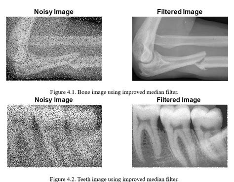 Abdulaziz Alhussain On Linkedin Imageprocessing Digitalsignalprocessing Noisereduction