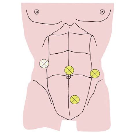 Trocar Placement In Laparoscopic Appendectomy Umbilical Position For Download Scientific