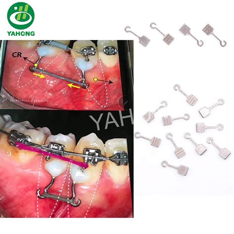 Dental Consumables Orthodontic Bondable Monoblock Crimpable Hook Buy Crimpable Hook