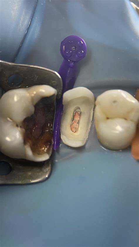 Deep Margin Elevation Myzerodonto