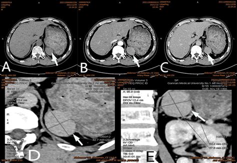 Frontiers Case Report Misdiagnosis Of Accessory Spleen In The Left