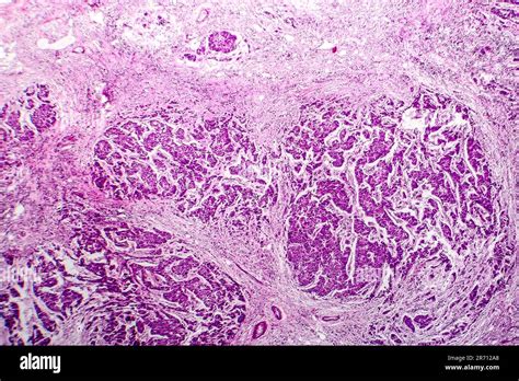 Lymph Node Metastasis Light Micrograph Of Cancer That Has Spread To A