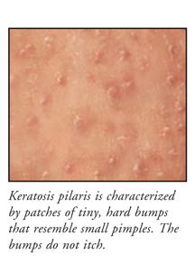 Keratosis Pilaris