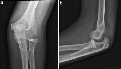 Elbow Avulsion Fracture Protocol Yzzgl