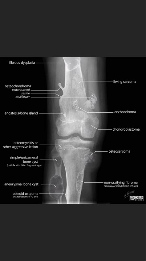 Pelvic Apophyseal Avulsion Fractures Annotated Image Artofit