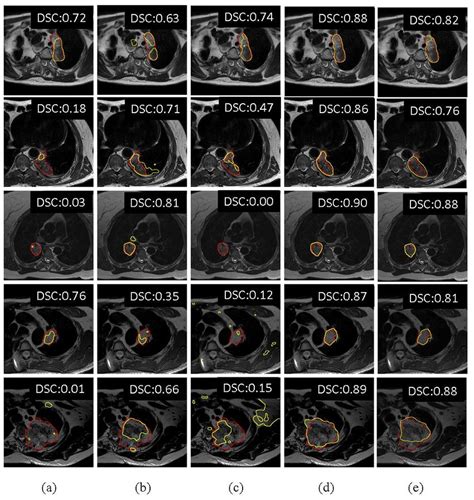 Segmentations From Representative Examples From Five Different Patients