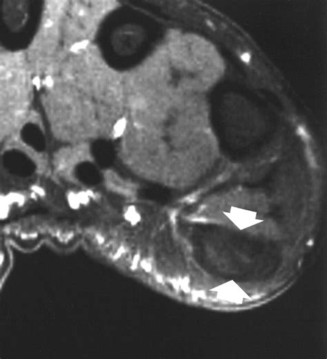 Fibroma Of Tendon Sheath