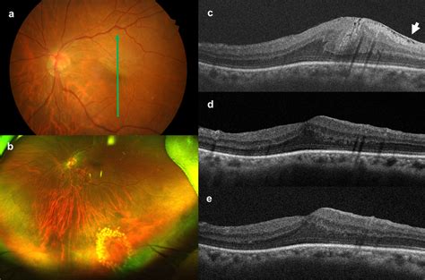 A Representative Case Of An Epiretinal Membrane Erm Secondary To Download Scientific Diagram