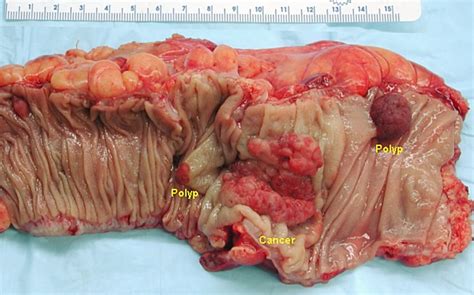 Rectal Polypectomy