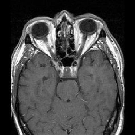 Brain Tumor Detection Object Detection Dataset And Pre Trained Model By Abilaash S S