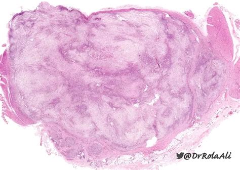 Nodular Fasciitis Microscopic