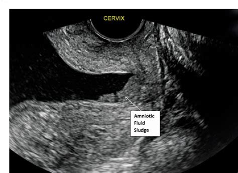 Ultrasound Fluid Around Cervix