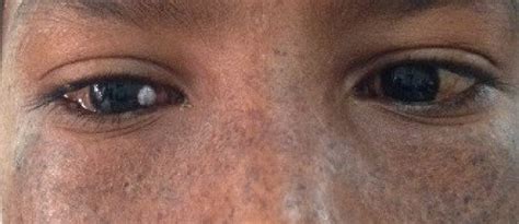 Patient Of Xeroderma Pigmentosum With Ossn In Right Eye Download