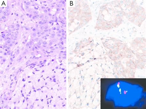 Adenocarcinoma Of The Lung With Acinar And Signetring Cell Growth