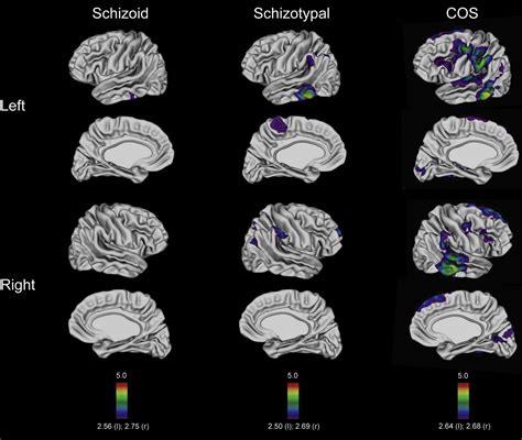 Severity Of Cortical Thinning Correlates With Schizophrenia Spectrum