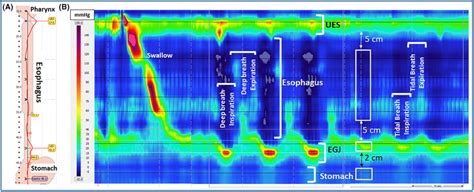 A Schematic Diagram Showing Position Of The Manometer Catheter In Download Scientific