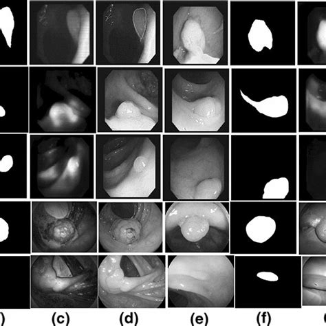 The Proposed Pipeline Of Polyp Delineation In Colonoscopy Video Frames Download Scientific Diagram