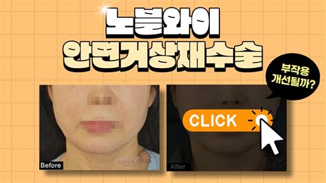안면거상 부작용 불만족 때문에 안면거상술재수술 전문병원 찾고있다면 ★더보기란 필독★ Youtube