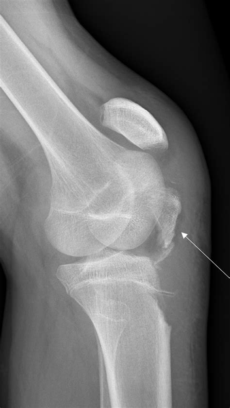 Em Ultrasound Section Cardiac Tamponade And Ultrasound Guided Pericardiocentesis