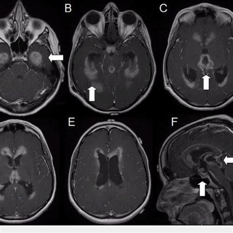 Post Contrast Axial And Sagittal Mri Sequences With Neuronavigation Download Scientific Diagram