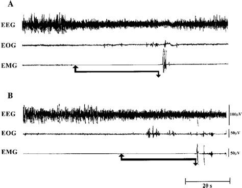 Polygraphic Records Of Eeg Eog And Emg Showing Signs Of Rem Sleep Download Scientific Diagram