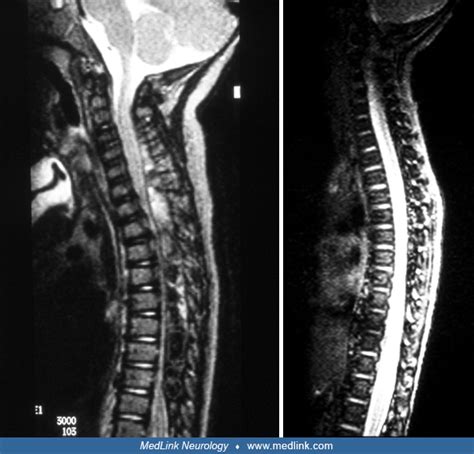Hemophilia And Other Coagulation Disorders Neurologic Aspects