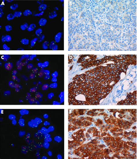 Fluorescence In Situ Hybridisation Fish And Immunohistochemistry