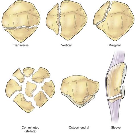 Fractures Of The Patella Musculoskeletal Key