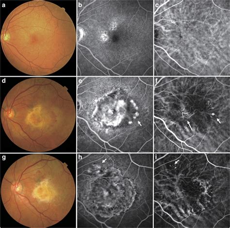 Development Of Polypoidal Lesions At The Terminus Of Newly Progressed
