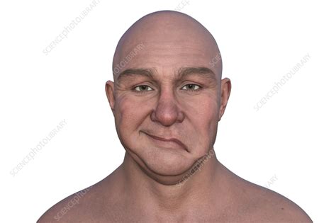 Left Side Stroke Illustration Stock Image F0436039 Science