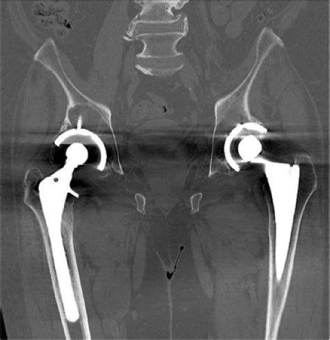 Classification Of Acetabular Defects In Revison Total Hip Arthroplasty And An Overview Of