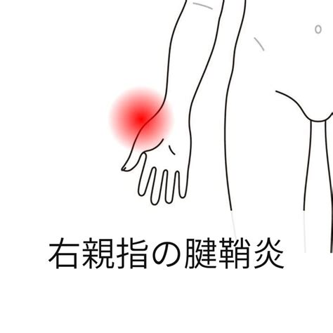 使い過ぎから発症した右親指の腱鞘炎｜腱鞘炎のツボ｜ツボネット 鍼灸の症例が検索できるツボ辞典