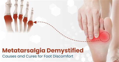 Metatarsalgia Demystified Causes And Cures For Foot Discomfort