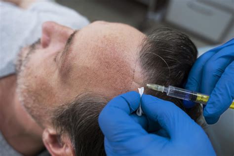 How To Choose A Hair Transplant Clinic Out Of Country