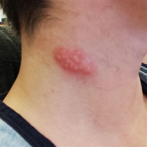 Neck Turning Red W White Bumps Itchystings Help Please R